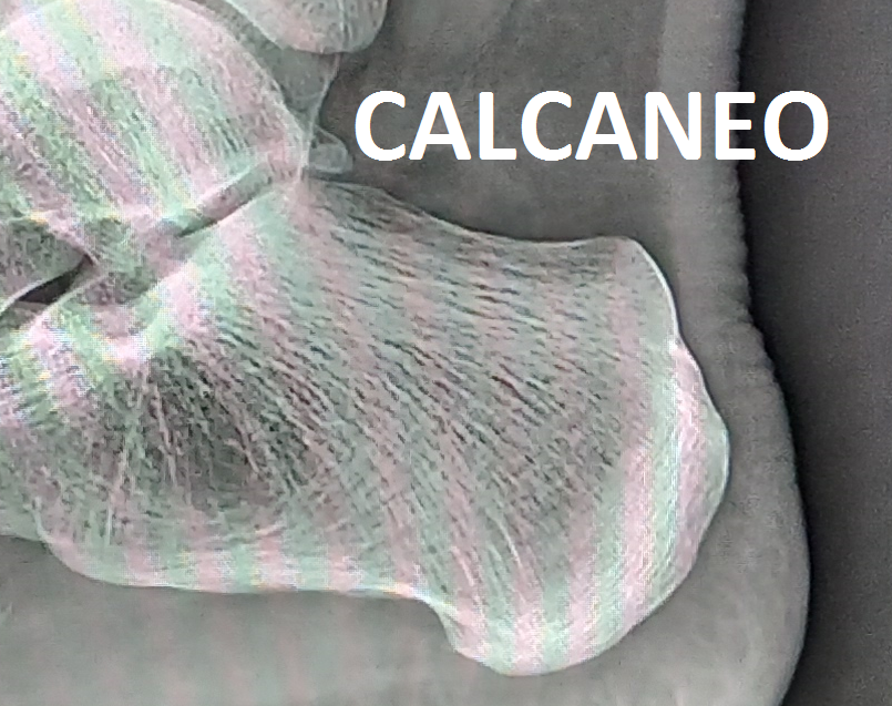 Patologias calcáneo – www.diagnosticoximagen.com